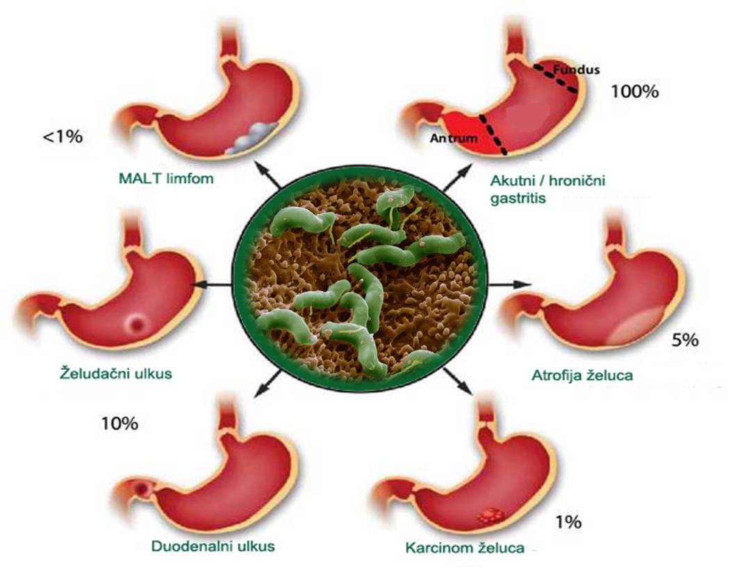 PDF Helicobacter Pylori Eradication Or Preservation 45 OFF